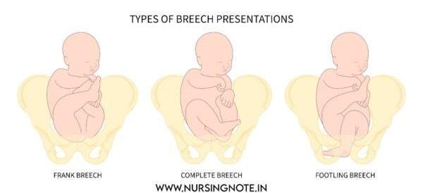 Breech Presentation: Definition,Type, Etiology and Mechanism for 3rd ...