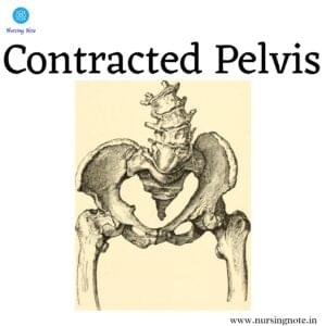 Contracted Pelvis: Definition, Causes, Signs, Diagnosis, Complication ...